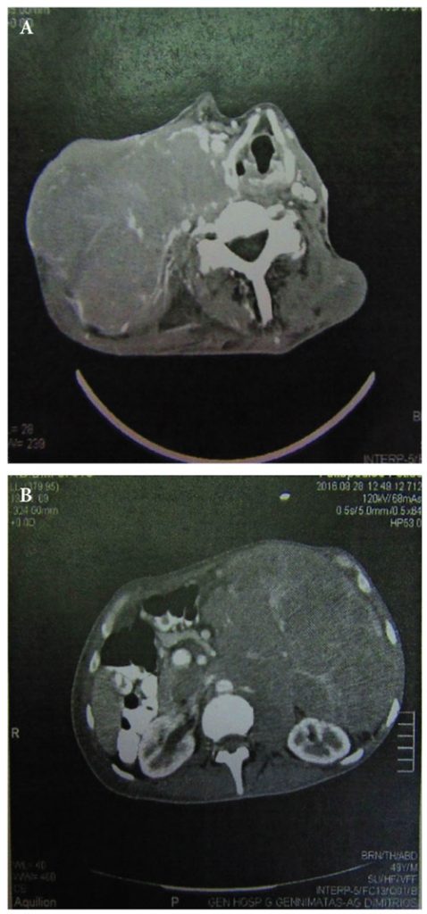 Elevated Soluble Transferrin Receptor (sTfR) in A Patient with High ...