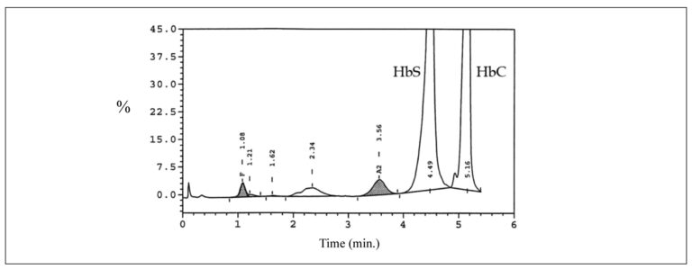 Haemoglobin electrophoresis and HPLC – HAEMA