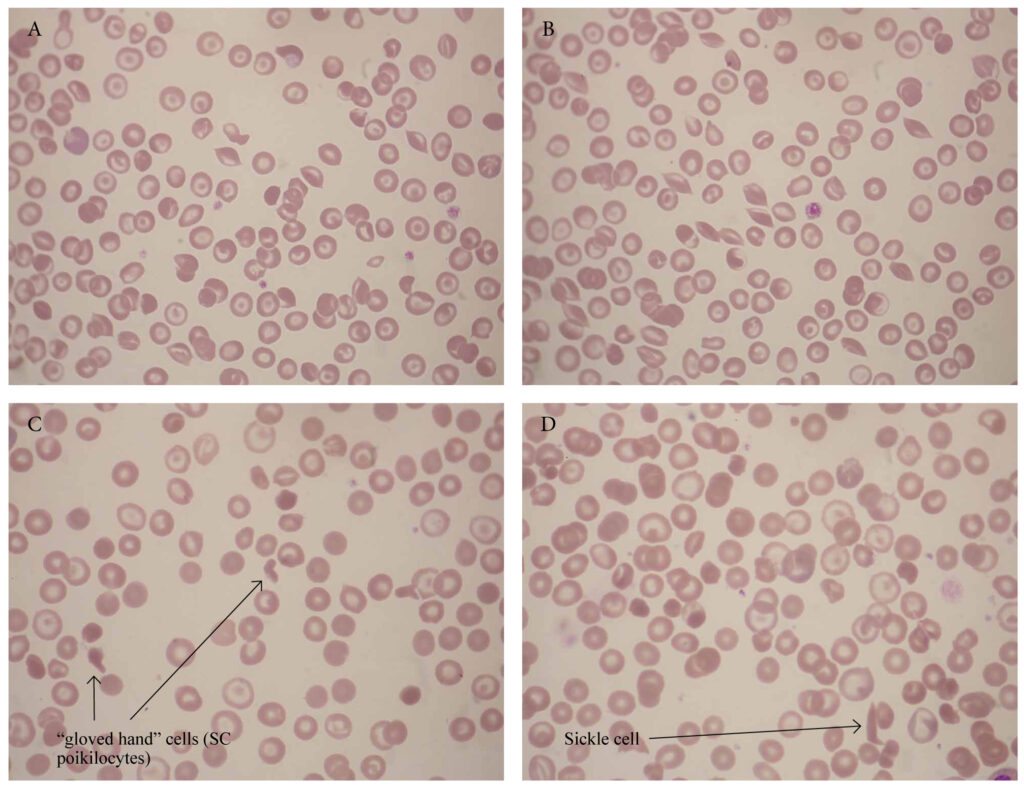 Genetic Blood Dyscrasias – HAEMA